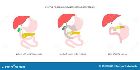 Pancreaticoduodenectomy Clipart And Illustrations