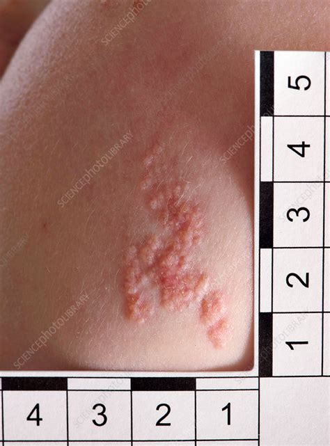 Linear Epidermal Naevus Stock Image C038 2315 Science Photo Library