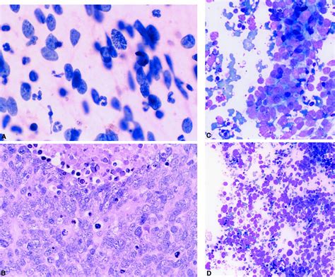 A Review Of Cytologic Findings In Neuroendocrine Carcinomas Including