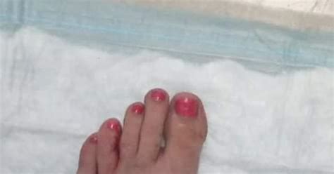 Possible Broken Toe Foot