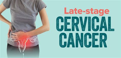 Late Stage Cervical Cancer Womens Voice Us