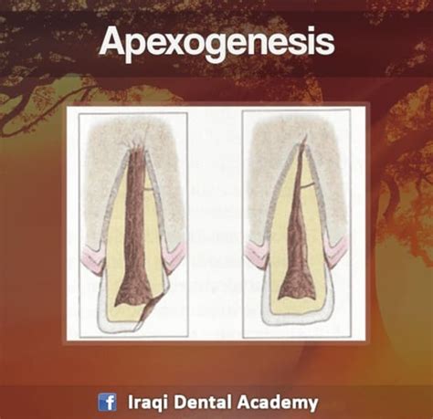 Apexogenesis And Apexification Pptx Dental Health Diseases And
