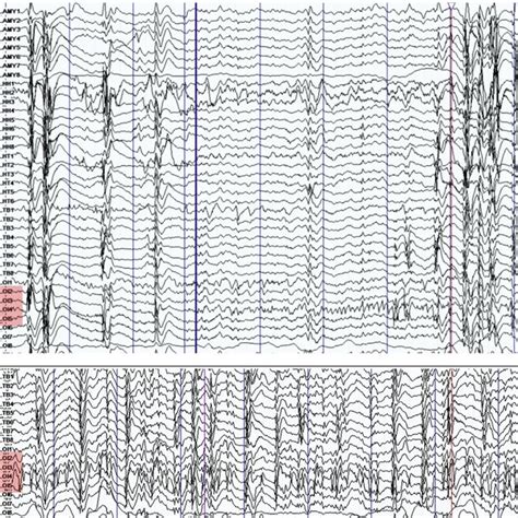 Case Example Seizure 2 Intracranial Eeg Recording Of Ictal Onset From Download Scientific