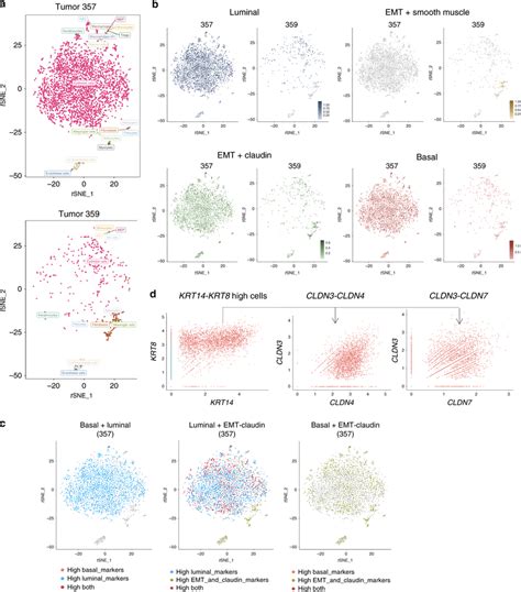 Single Cell Transcriptome Profiling Of Human Mibcs A Tsne Plots Showing