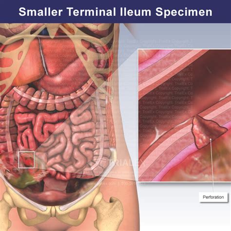 Medical Legal Exhibits Legal Animations And Trial Graphics