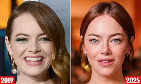 Plastic Surgeons Expose Best Kept Beauty Secrets Behind Emma Stones