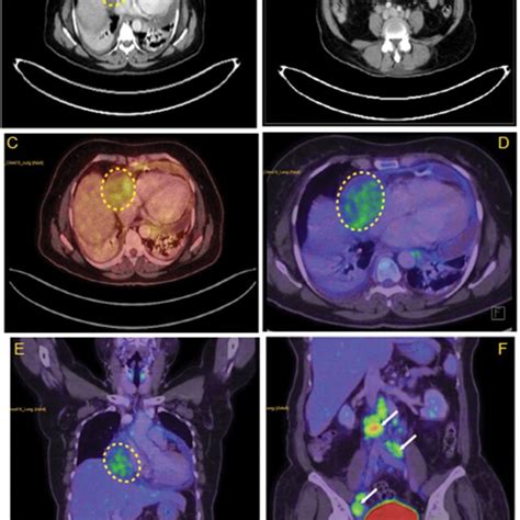 Lymph Node Characteristics In The Right Atrium A Cect Thorax Download Scientific Diagram