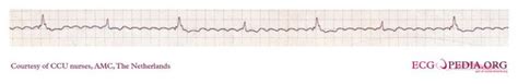 Telemetry And Ekg Basics Rhythm Recognition