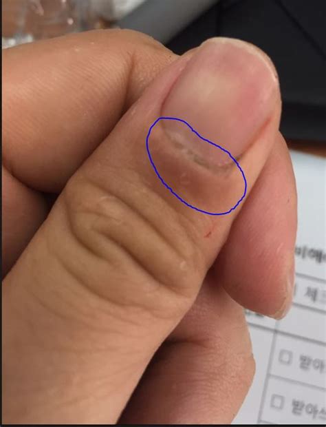 왼손 엄지 손가락 손톱위가 엄청 아파요 ㅠㅠ 골프포럼 딜바다닷컴