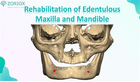 Fixed Dentures For Atrophic Maxilla And Mandible Using 3d Printed Patient