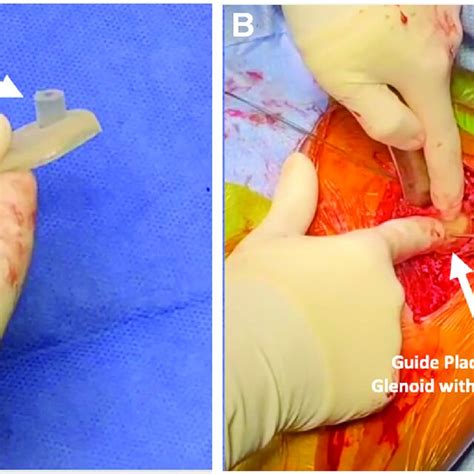 Processing And Curing Of Patient Specific Instrumentation Glenoid Guide Download Scientific