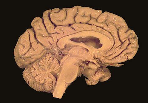 Saggital View Of Brain Diagram Quizlet