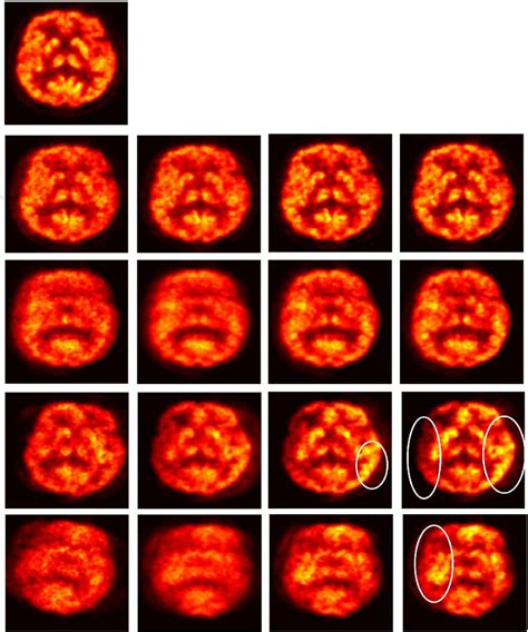 L To R Inter Frame Motion Corrected Only Deconvolution Iterations 2
