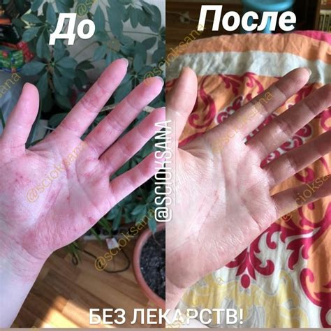 Экзема это беда Scioksana© Ролекс в ЗОЖ Дзен