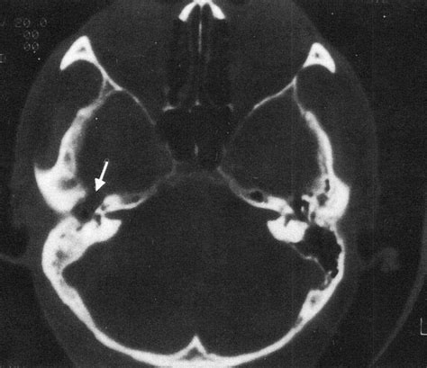 第七节 恶性肿瘤 眼耳鼻咽喉疾病影像学图鉴
