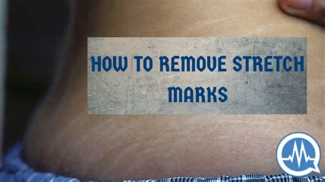 AskDrMalik HOW DO I REMOVE STRETCH MARKS PERMANENTLY Ask Dr Malik