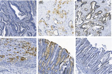 Immunohistochemical Staining Of Hla‐g In Colorectal Cancer Download Scientific Diagram