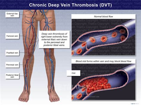 Chronic Deep Vein Thrombosis Dvt Trialquest Inc