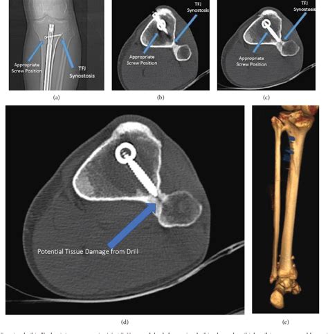 Tibiofibular Joint Structure Semantic Scholar