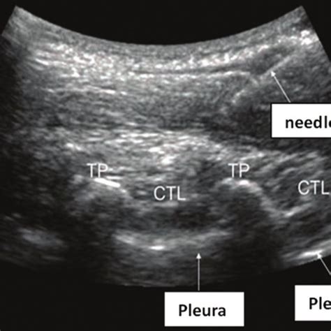 Ultrasound Scan Of The Thoracic Paravertebral Space At T4 Level Using Download Scientific
