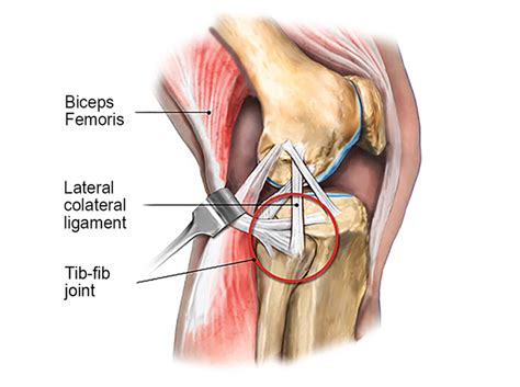 Tib Fib Fixation And Knee Pain Erik Dalton Blog
