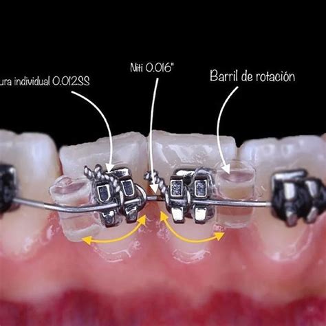 2pcs bag orthodontic rotation wedges torsion pad dental rotating wedge rotational torque for
