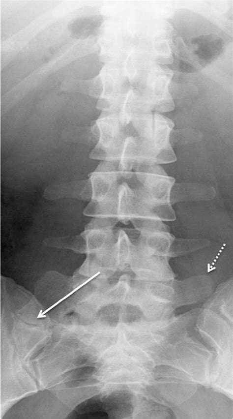 Sesamoid Ossicle Of Nuchal Ligament Artofit