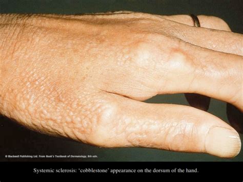 Scleroderma Systemic Sclerosis Flashcards Quizlet