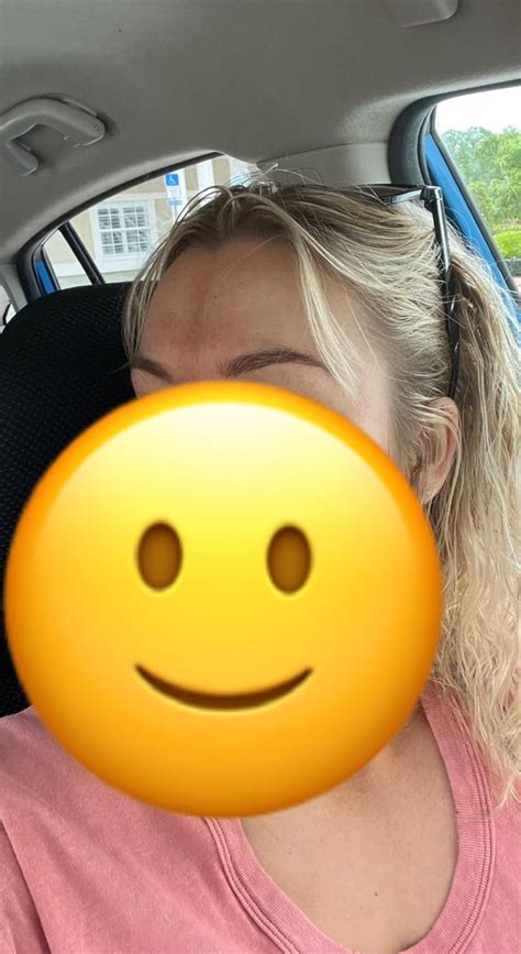 My Linear Scleroderma Story I Actually Diagnosed Myself With Ls It