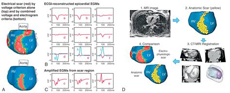 Noninvasive Electrocardiographic Imaging Of Arrhythmogenic Substrates And Ventricular