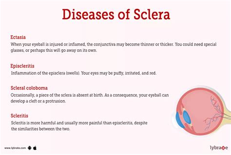 Sclera Human Anatomy Image Functions Diseases And Treatments