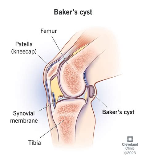 Cyst