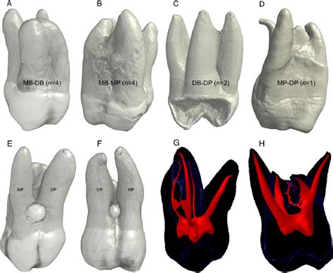 Maxillary Molar Root Canal