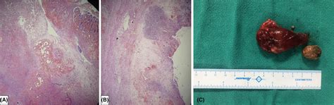A Mucosal Ulceration And Denudation With Infiltration By Neutrophils Download Scientific
