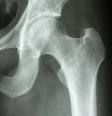 Bone Densitometry Milpark Radiology Incorporated
