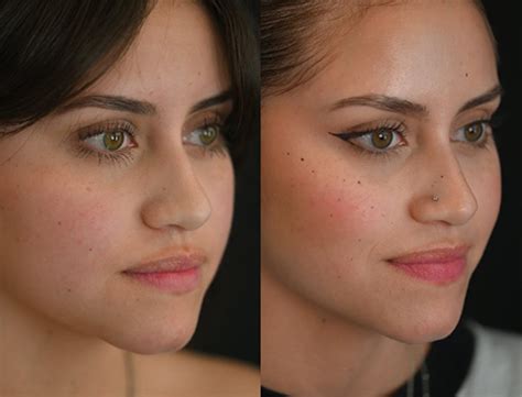 Chin Reduction Beverly Hills CA Los Angeles Dr Sykes