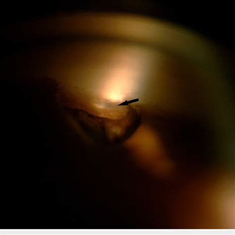 Gonioscopy Showing The Surgical Iridectomy And The Patent Internal