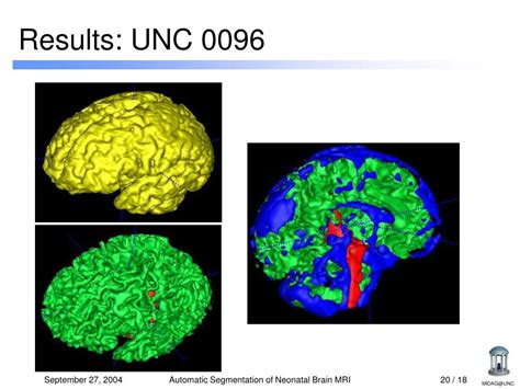 Ppt Automatic Segmentation Of Neonatal Brain Mri Powerpoint Presentation Id 735917