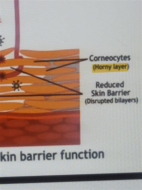 Some Of You Have Large Corneocytes Rgaybroteens