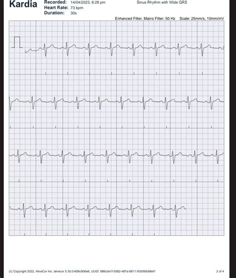 Sinus Rhythm With Wide Qrs R Readmyecg