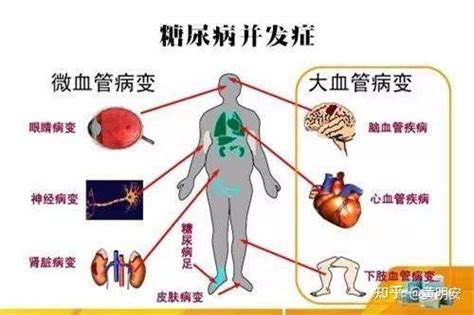 糖尿病还在只看血糖？这9大并发症需要了解 知乎