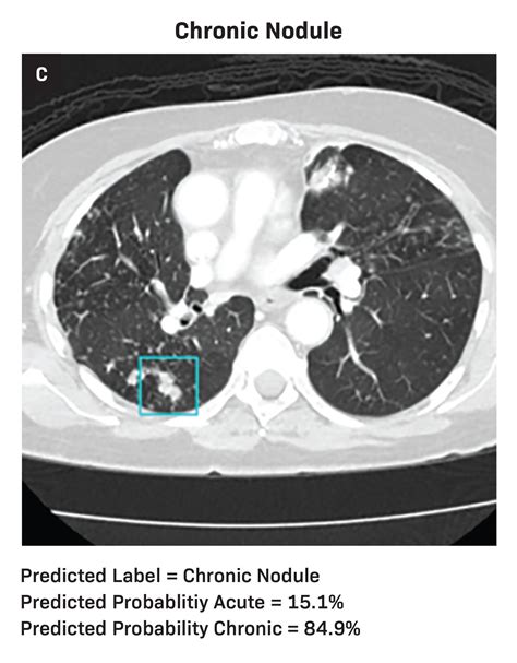 Automated Machine Learning With Radiomics For Predicting Chronicity Of Pulmonary Nodules In