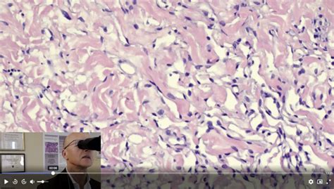 Radiation Induced Angiosarcoma With Negative C Myc Or Atypical Vascular Lesion Dermpedia