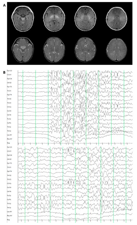 Brain Magnetic Resonance Imaging Mri And Electroencephalography Eeg