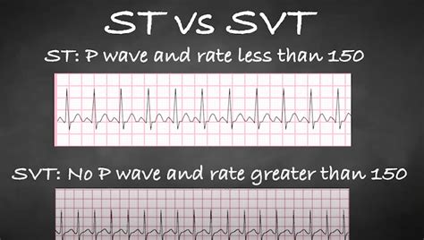 Tachycardia With A Pulse Algorithm Explained Acls Certification