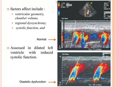 Diastolic Dysfunction 2016 Pptx Heart And Cardiovascular Diseases Diseases And Conditions
