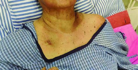 V Sign Is A Patchy Or Discrete Macular Erythema Over The Sunexposed Download Scientific Diagram