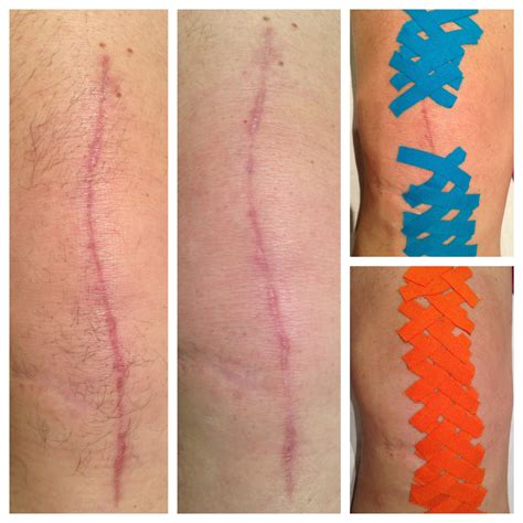How To Break Up Scar Tissue After Knee Surgery Howsolut
