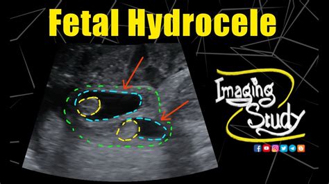 Fetal Bilateral Hydrocele Ultrasound Case 315 Youtube