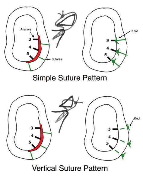 Basic Suture Patterns My Xxx Hot Girl